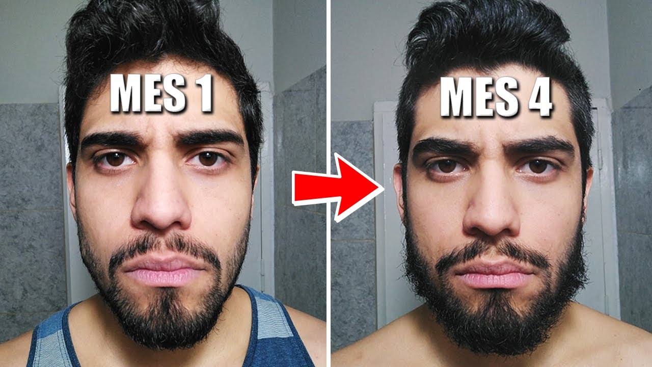 MINOXIDIL: LO BUENO y LO MALO tras 4 MESES de USO: 7+1 Tips - YouTube