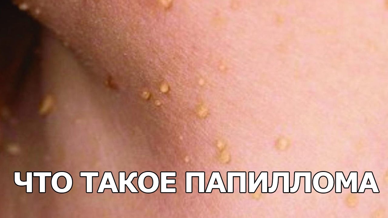 Папиллома — что это? - YouTube