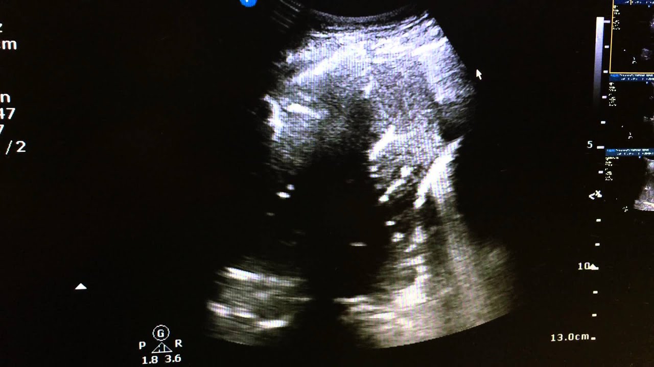 Ultrasonic dynamic air bronchograms - YouTube