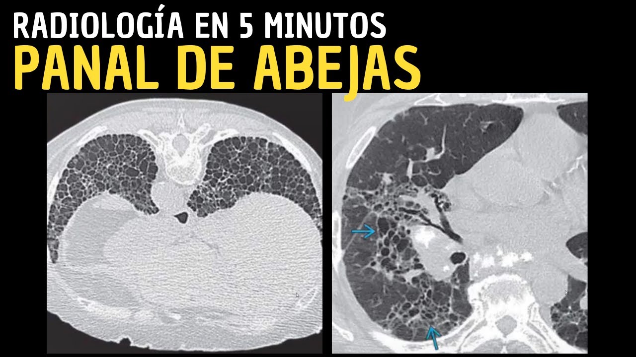 Radiología en 5 minutos: Signos radiológicos pulmonares: Panal de ...