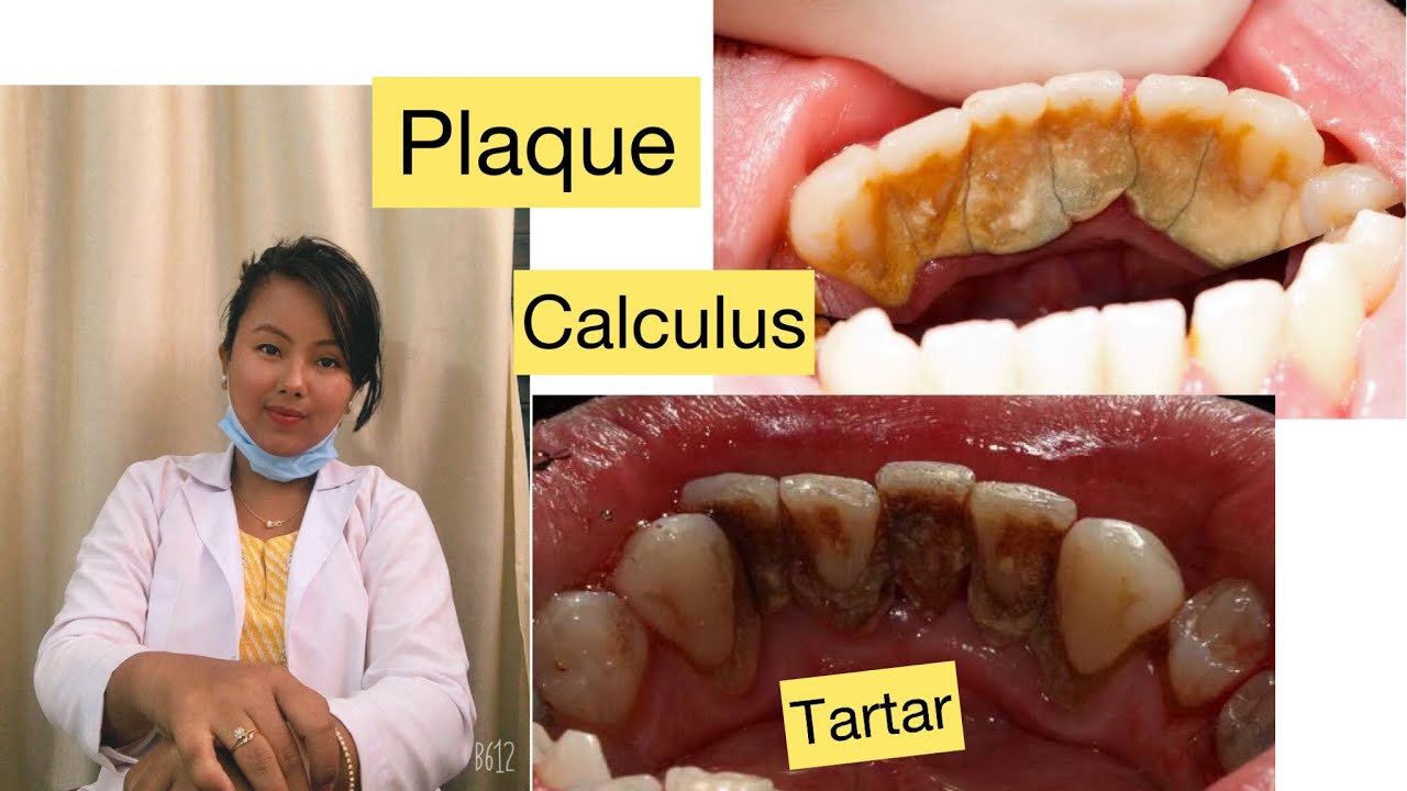 Dental plaque/calculus/tartar/Biyw Manw jayw ...