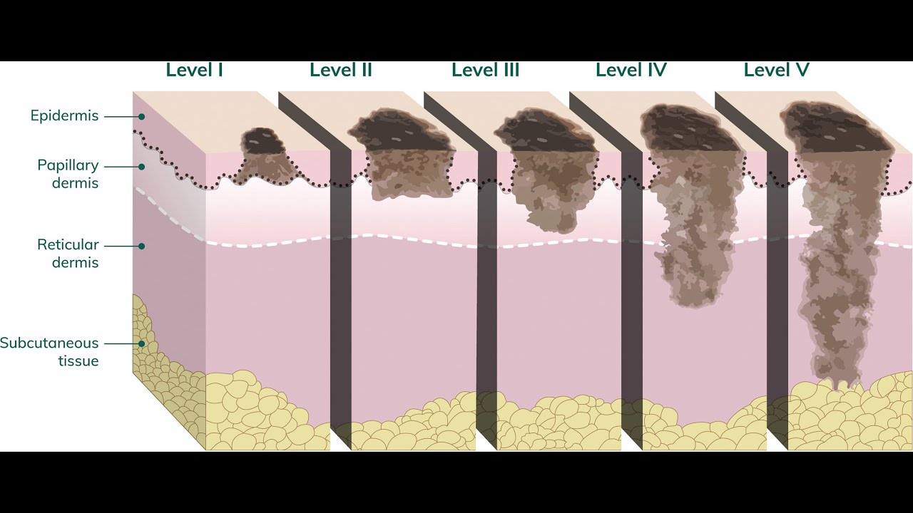 Breslow thickness measurement used in the staging of melanoma (Skin ...