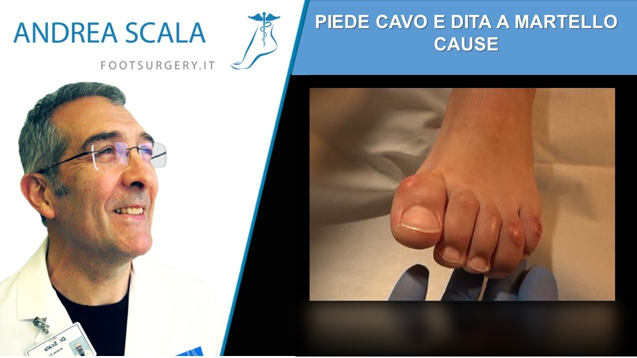 Piede cavo: come riconoscerlo| Caratteristiche, sintomi e cure | Dott ...