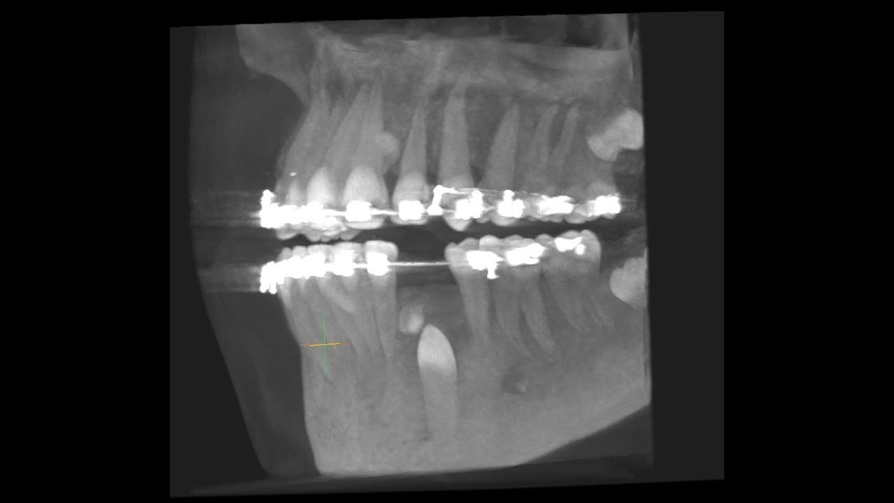 Surgical-Orthodontic Traction /of Impacted Canine By:Dr Anwar Al ...