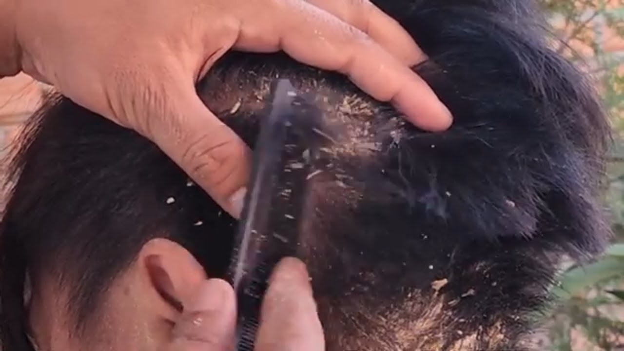 ASMR Scalp Scratching for Sleep and Relaxing Care #557 - YouTube
