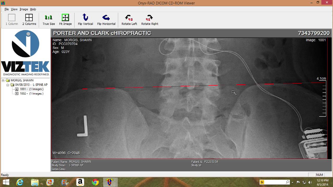 Bertolotti's Syndrome - YouTube