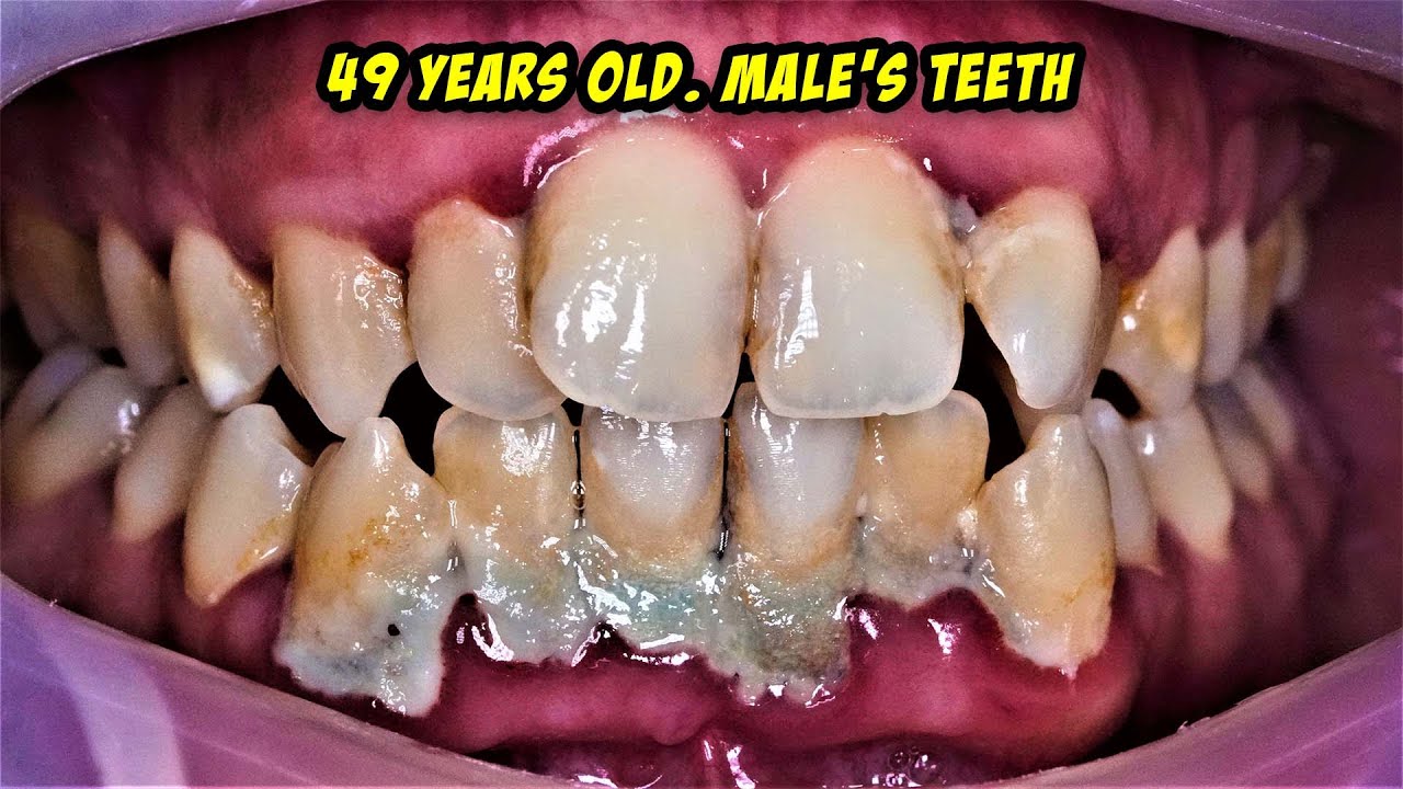 Don't Be Lazy To Clean Your Teeth, Teeth Are A Valuable Asset ...