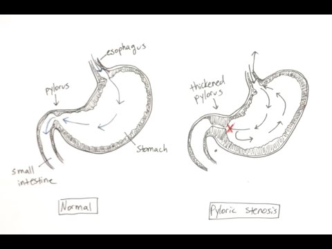 Pyloric stenosis patient education video - YouTube