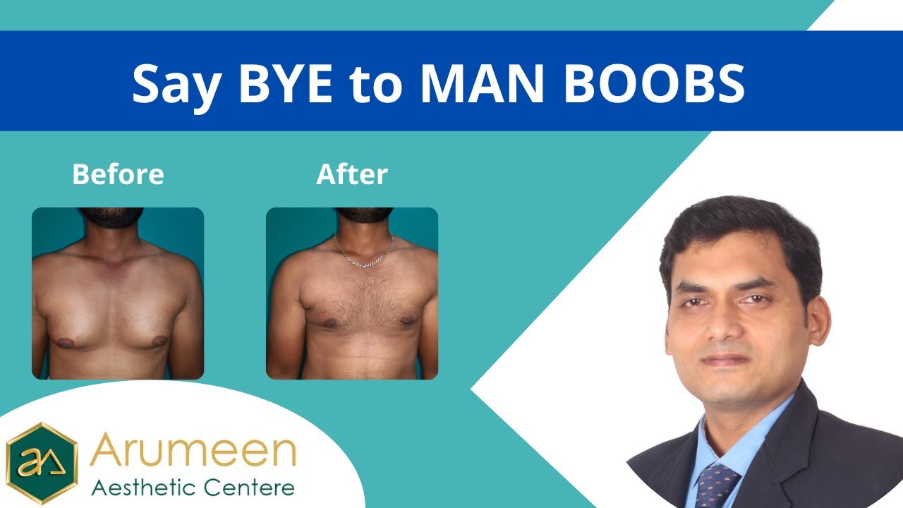 Say BYE to MAN BOOBS | Liposuction | Webster procedure |Gynecomastia ...