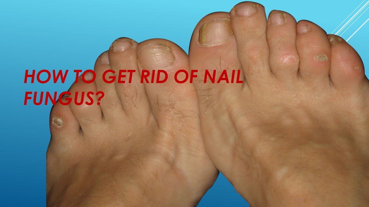How to Get Rid of Nail Fungus? - YouTube