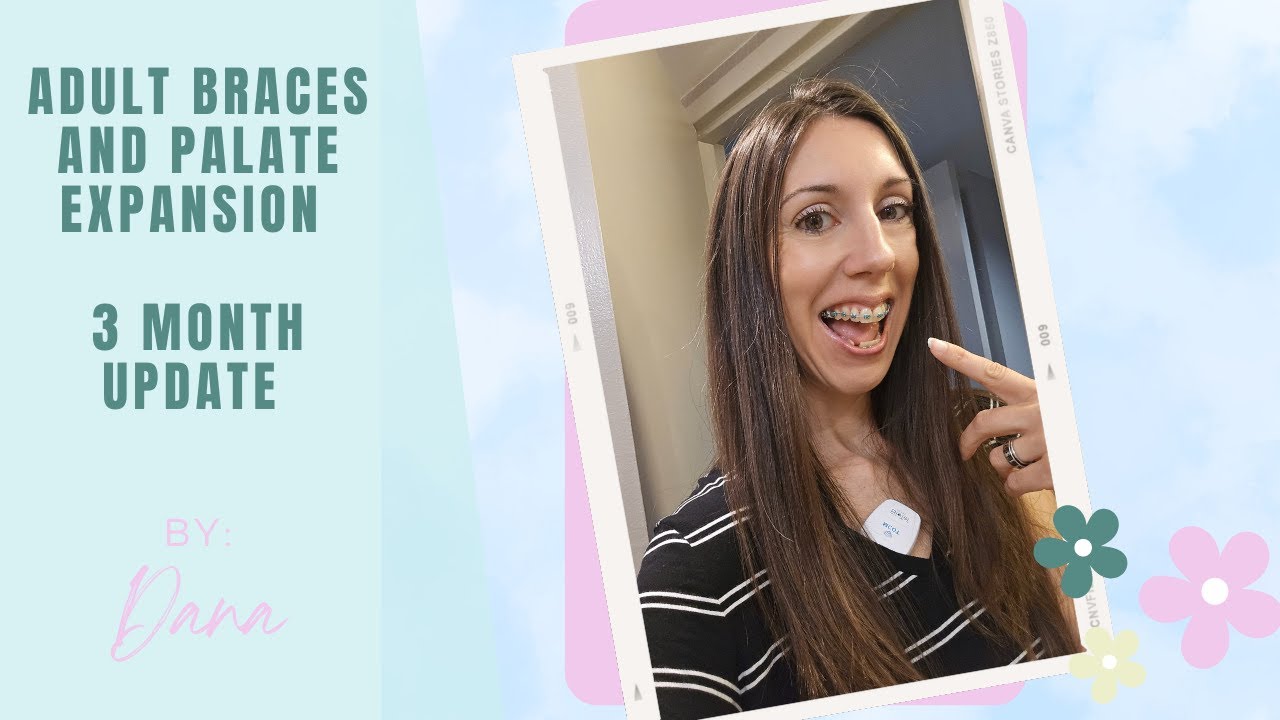 3 month update!! Adult braces and palate expander - YouTube
