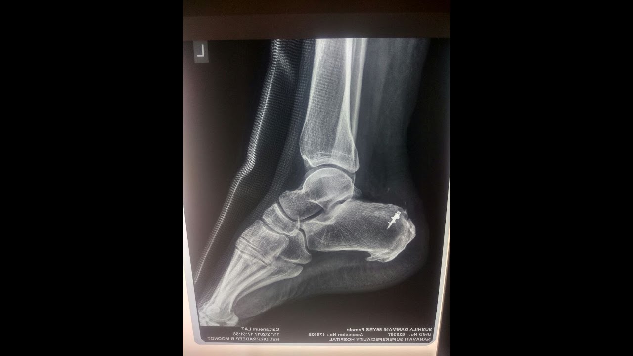 Repair of the achilles tendon after excision of Haglunds deformity with ...