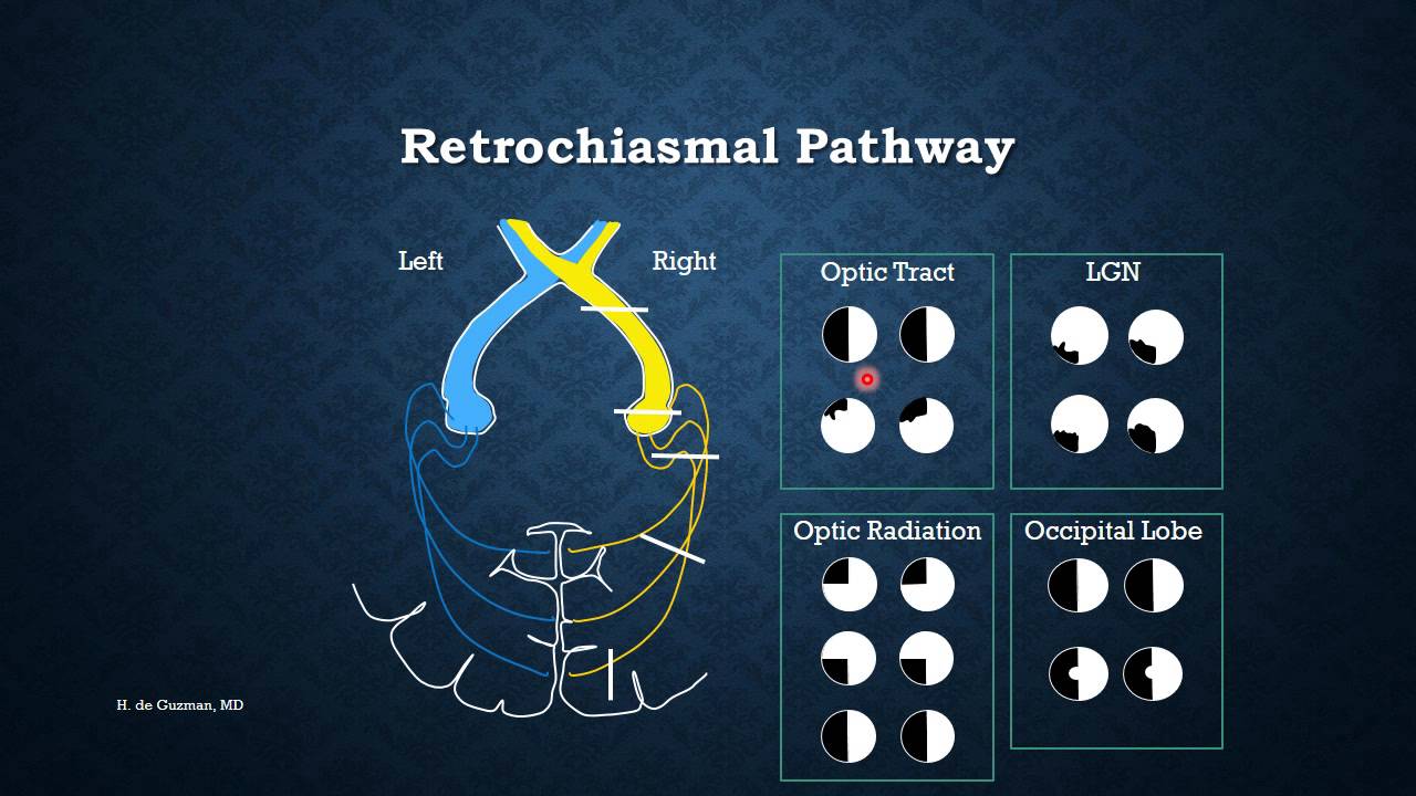 Visual Field: The Basics by Dr. Hannah de Guzman - YouTube