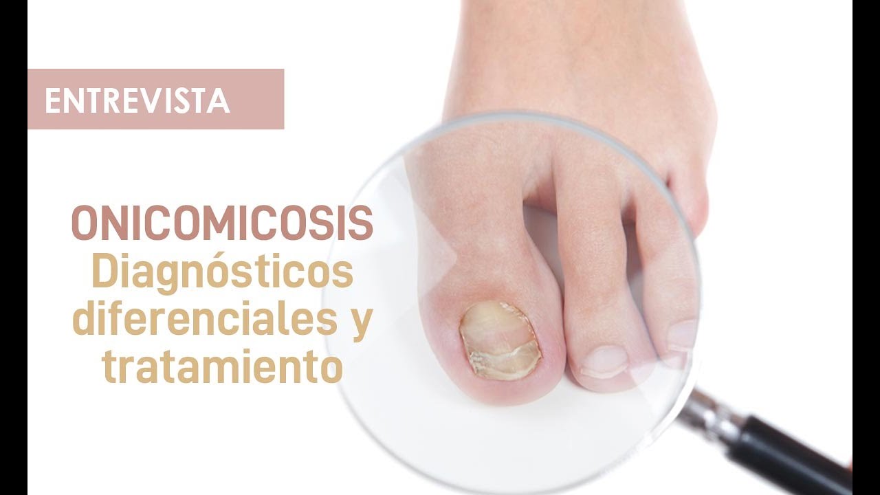 Onicomicosis: Diagnósticos diferenciales y tratamiento. - YouTube