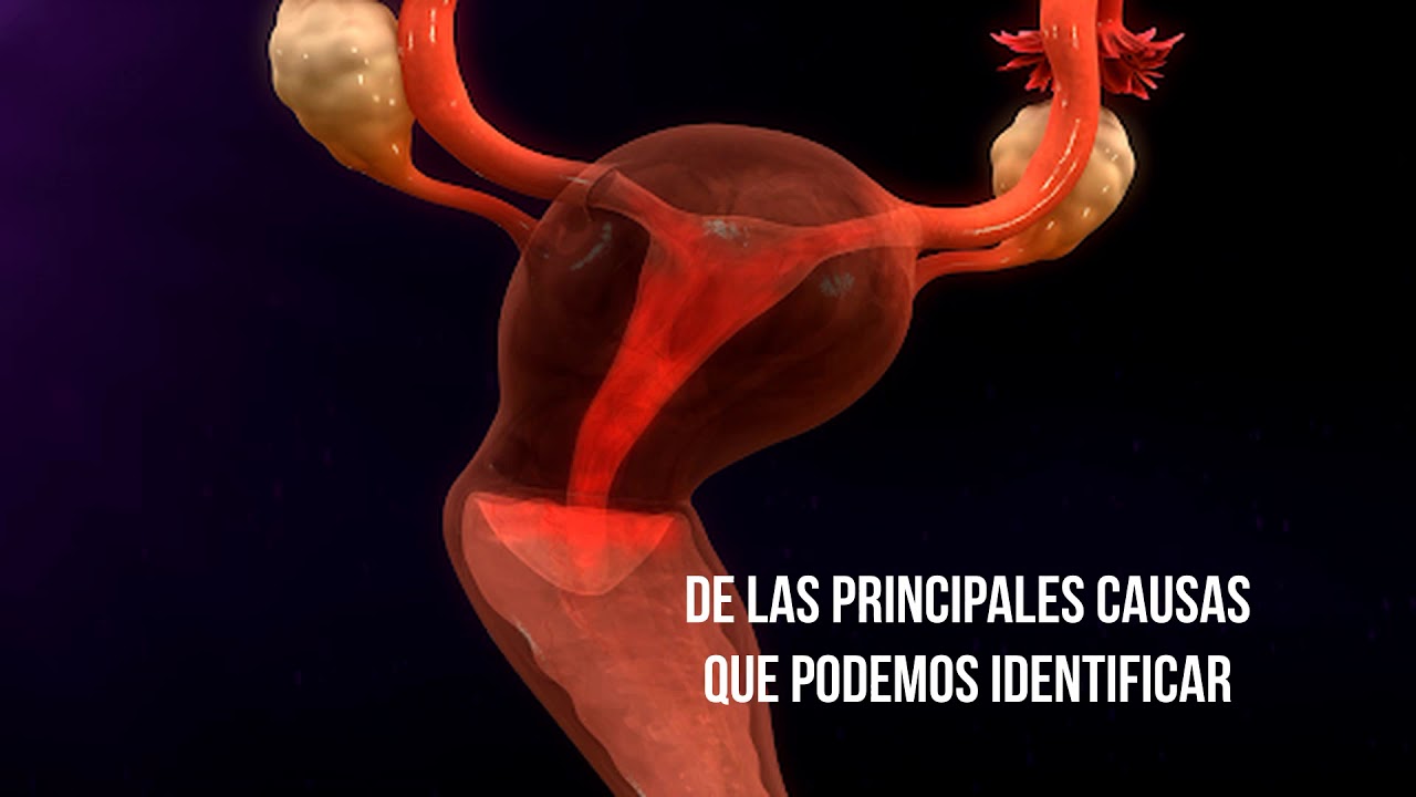 Sangrado Uterino Anormal - YouTube