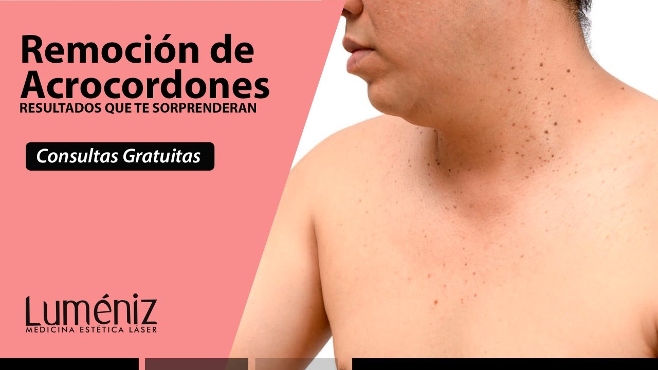 Remoción de Acrocordones - YouTube