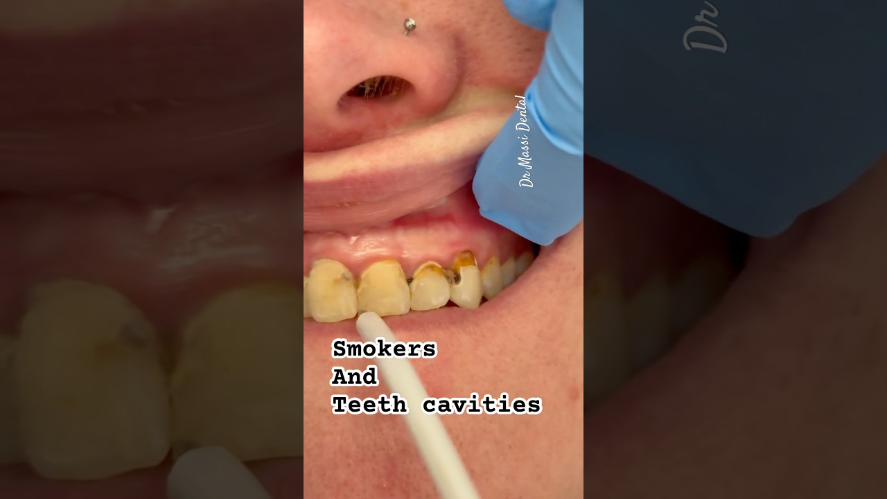 Smokers and teeth Cavities - YouTube