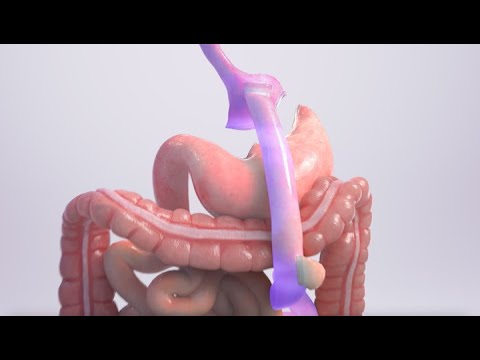 Gastric Bypass Revision (TORe procedure) Animation - YouTube