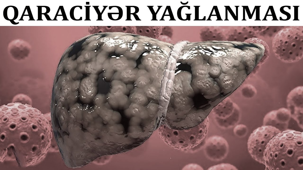 Qaraciyər yağlanmasından necə qurtulaq? - YouTube