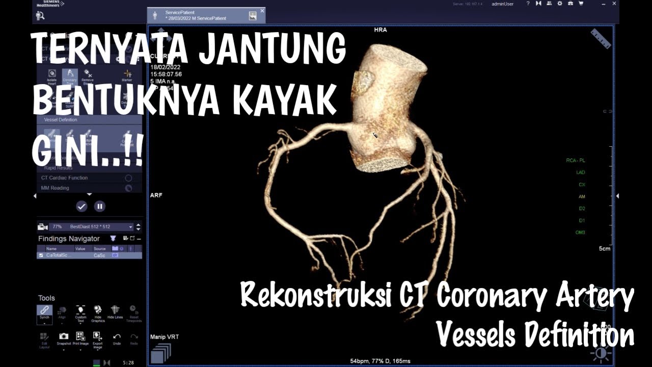 CT Cardiac Series #3 : Vessel Definition | Proses Rekonstruksi Pembuluh ...