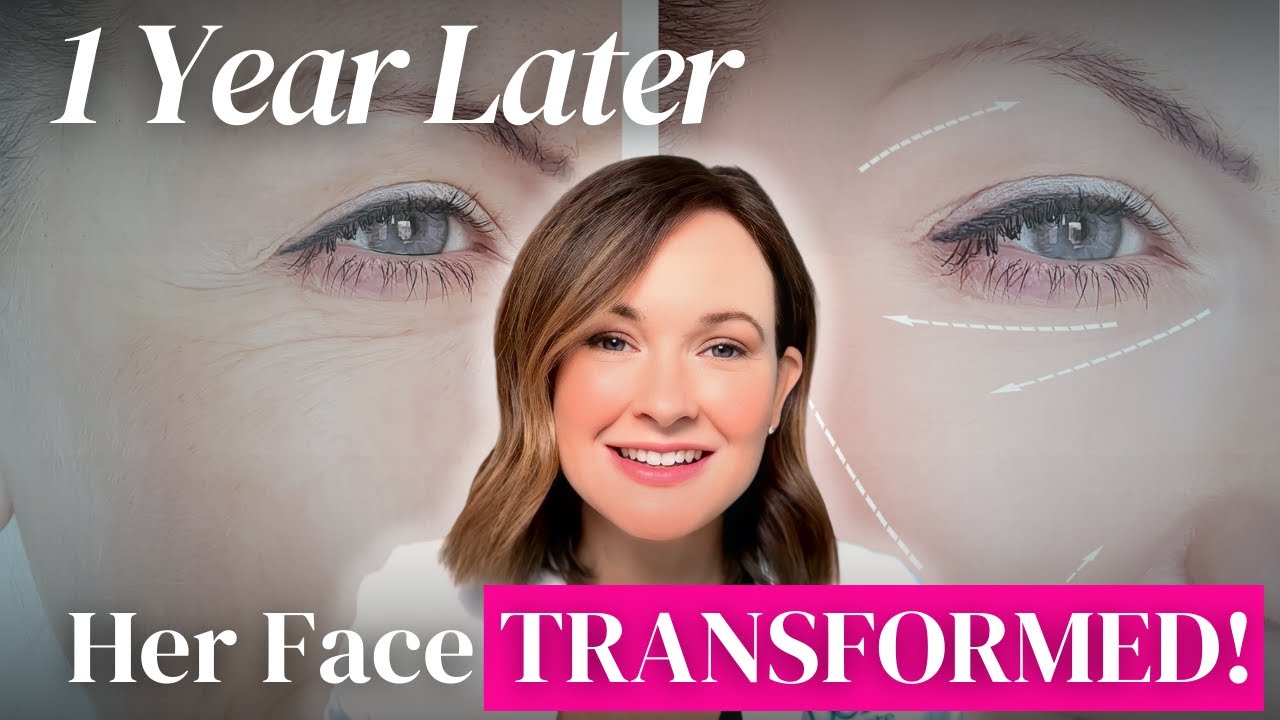 Anti-Aging Laser Case Study Stunning Results One Year Apart - YouTube