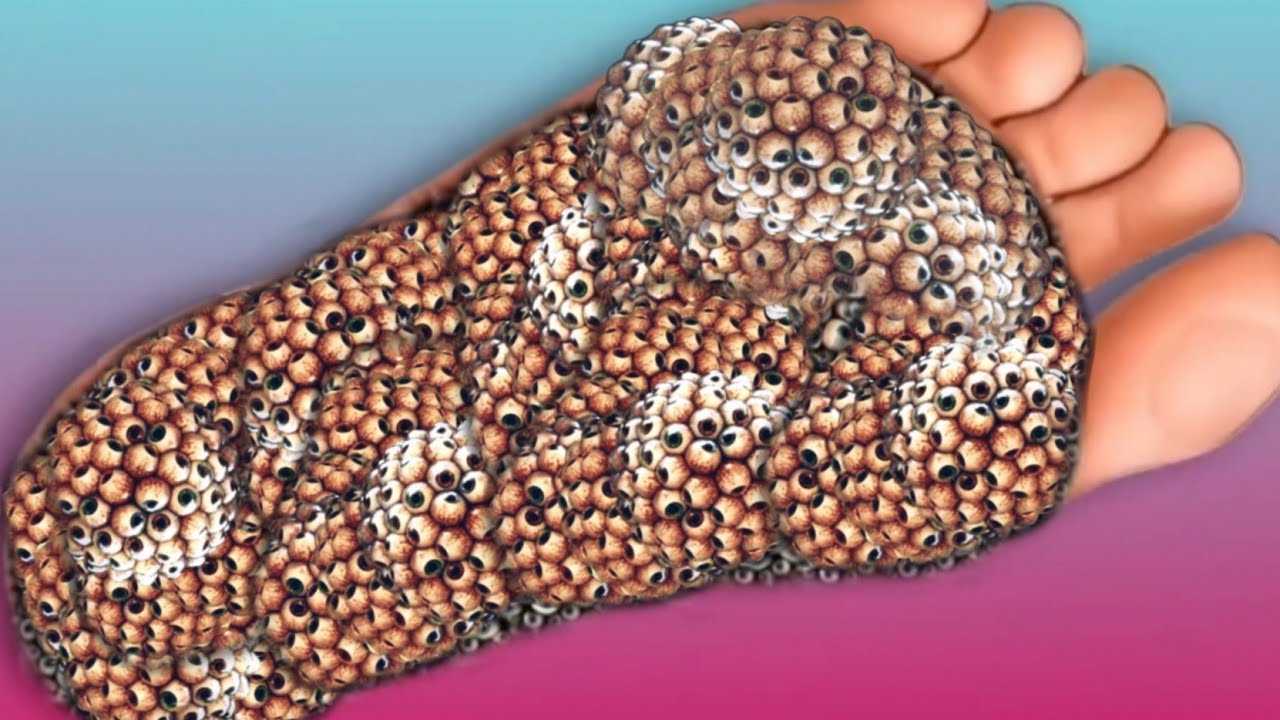 ASMR Treatment Foot | ASMR Maggots Infected Toe Animation 2D | ASMR ...