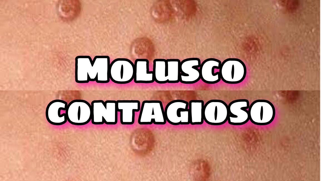 O QUE É MOLUSCO CONTAGIOSO? QUAIS OS SINTOMAS E TRATAMENTO PARA ...