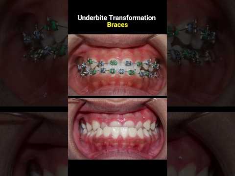 How Long Do Underbite Braces Last