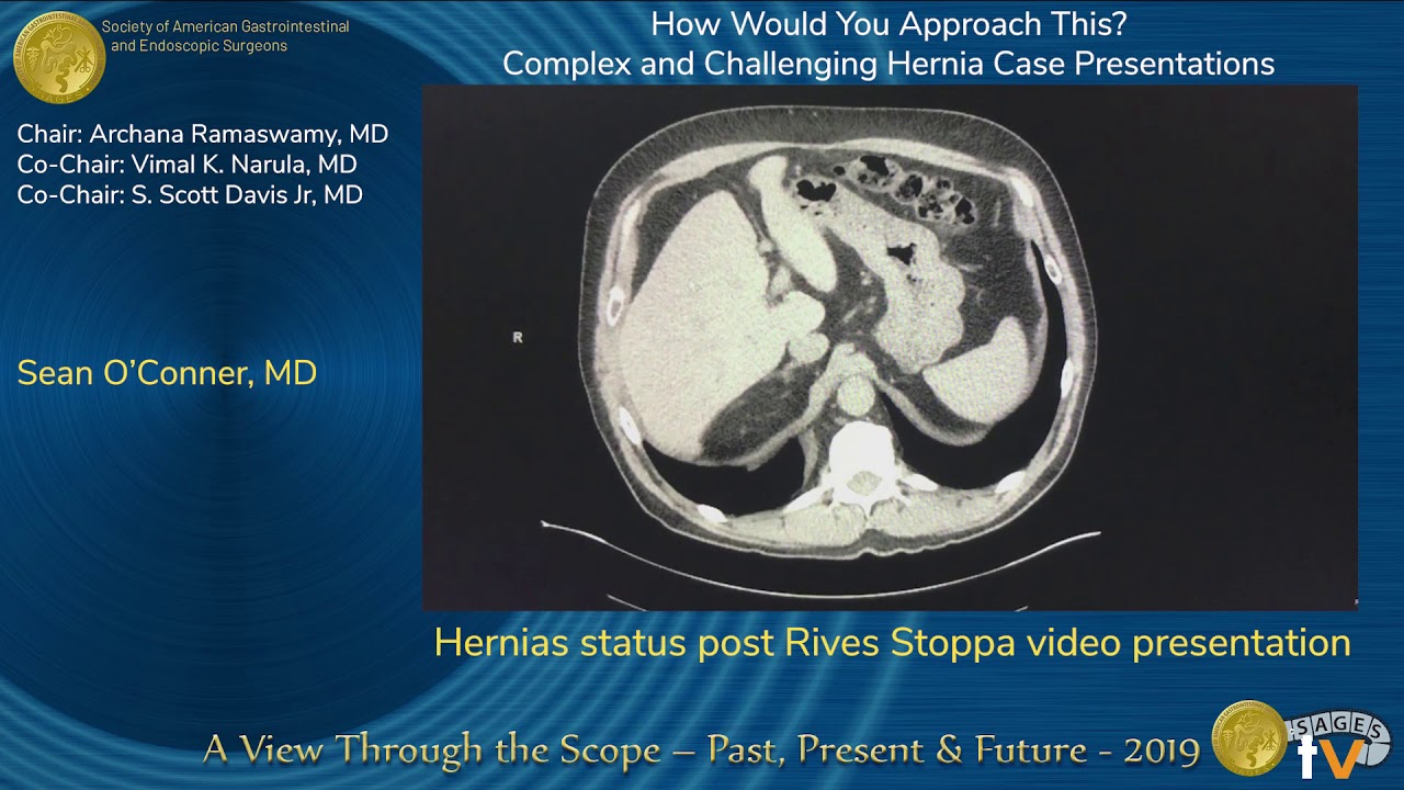 Interparietal Hernias after Robotic Rives-Stoppa hernia repair - YouTube