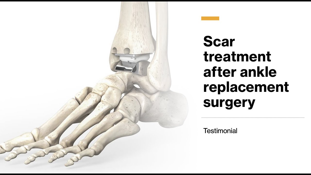 Ankle Replacement Scar Treatment - YouTube
