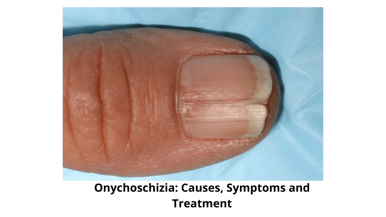 Onychoschizia Or nail splitting or brittle nails ; Definition, Causes ...