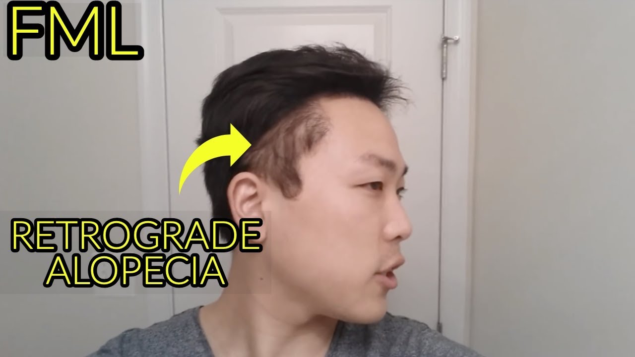 THE TRUTH ABOUT MY HAIR LOSS. - YouTube
