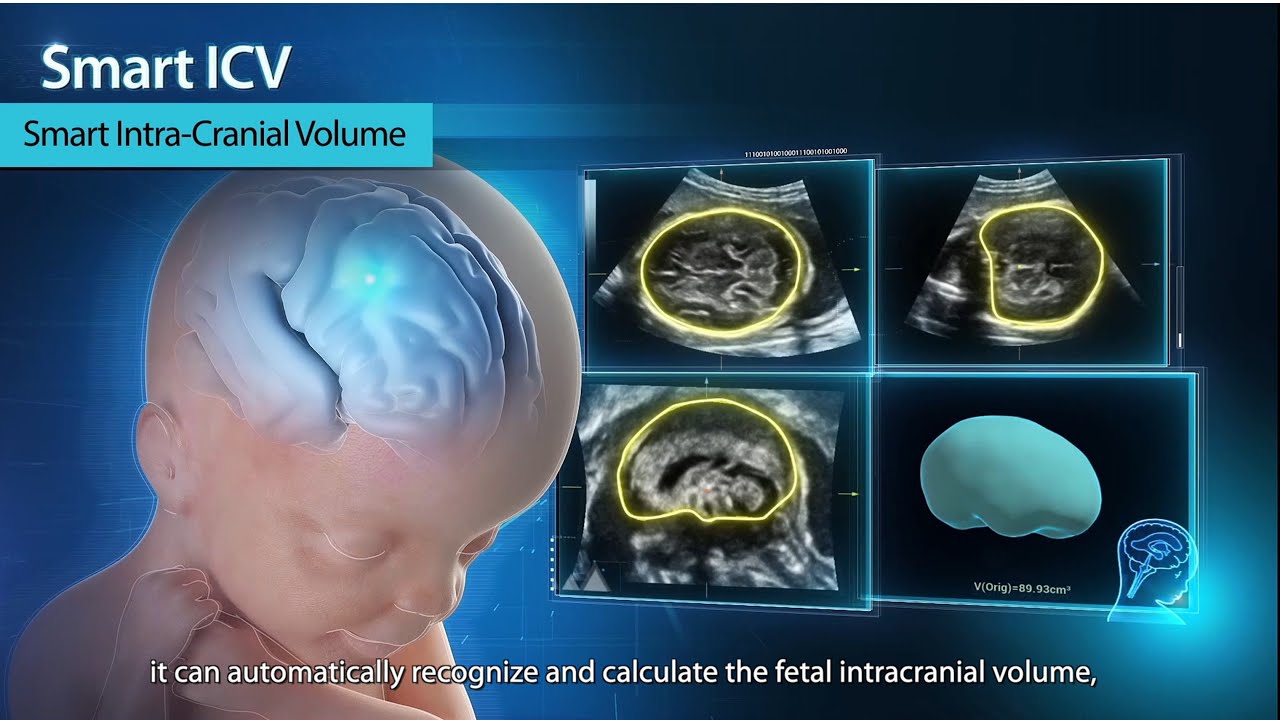 Mindray-Smart ICV Demonstration - YouTube