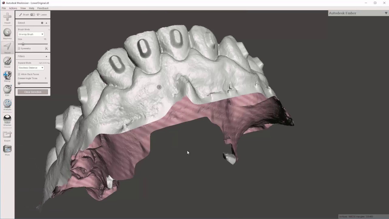 MeshMixer and Clear Aligner Ortho - Adding Buttons - YouTube