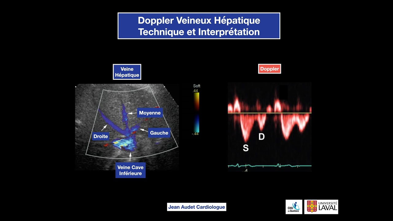 Le Doppler Veineux Hépatique en cardiologie. Hepatic Vein Doppler in ...