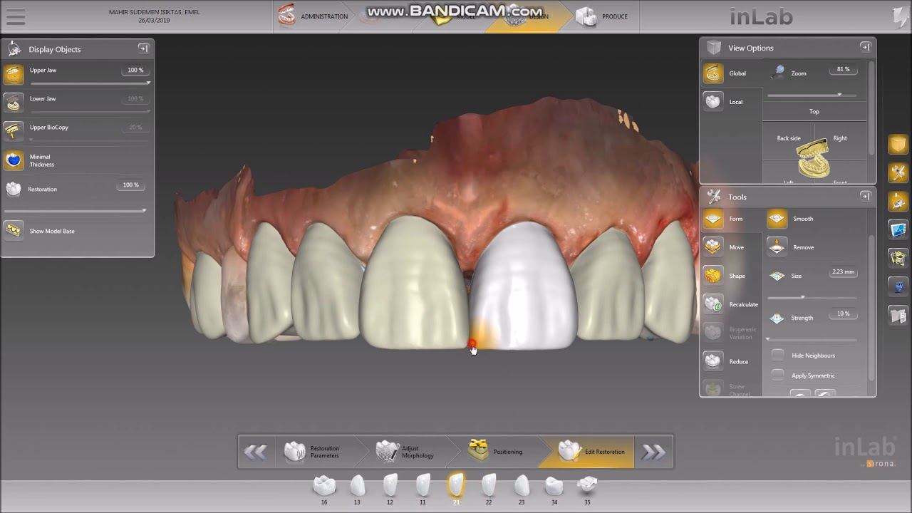 inLab SW 16 CAD Anterior Design on Sirona InLab 16 - YouTube