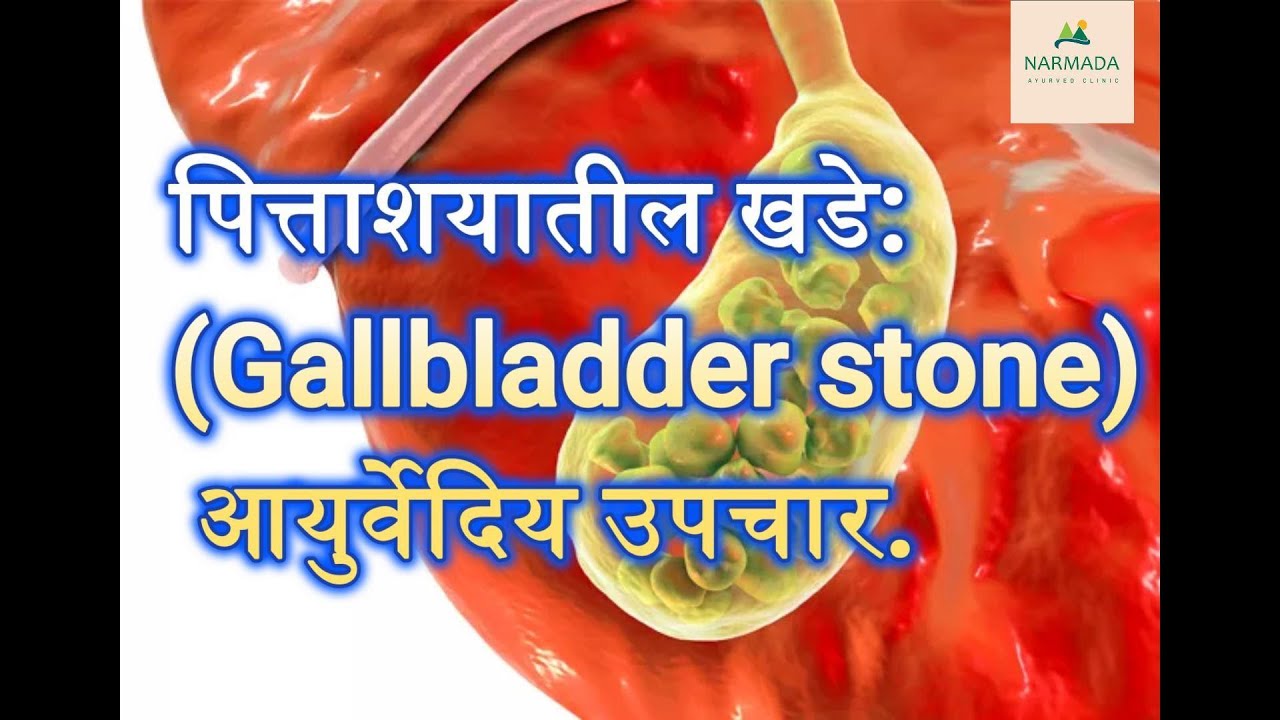 Ayurvedic Treatment For Gallbladder Stone |Marathi | - पित्ताशयातील खडे ...