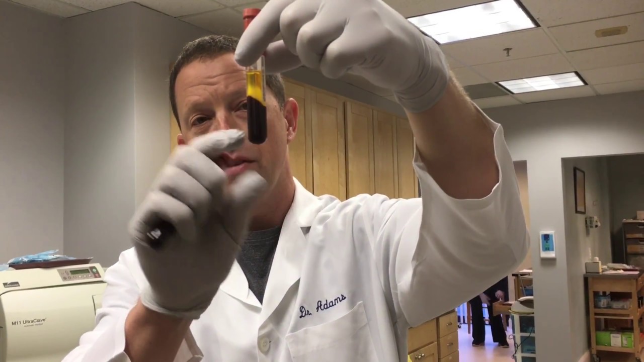 PRF Dental Platelet Rich Fibrin - Implants and Wisdom Teeth Surgery ...