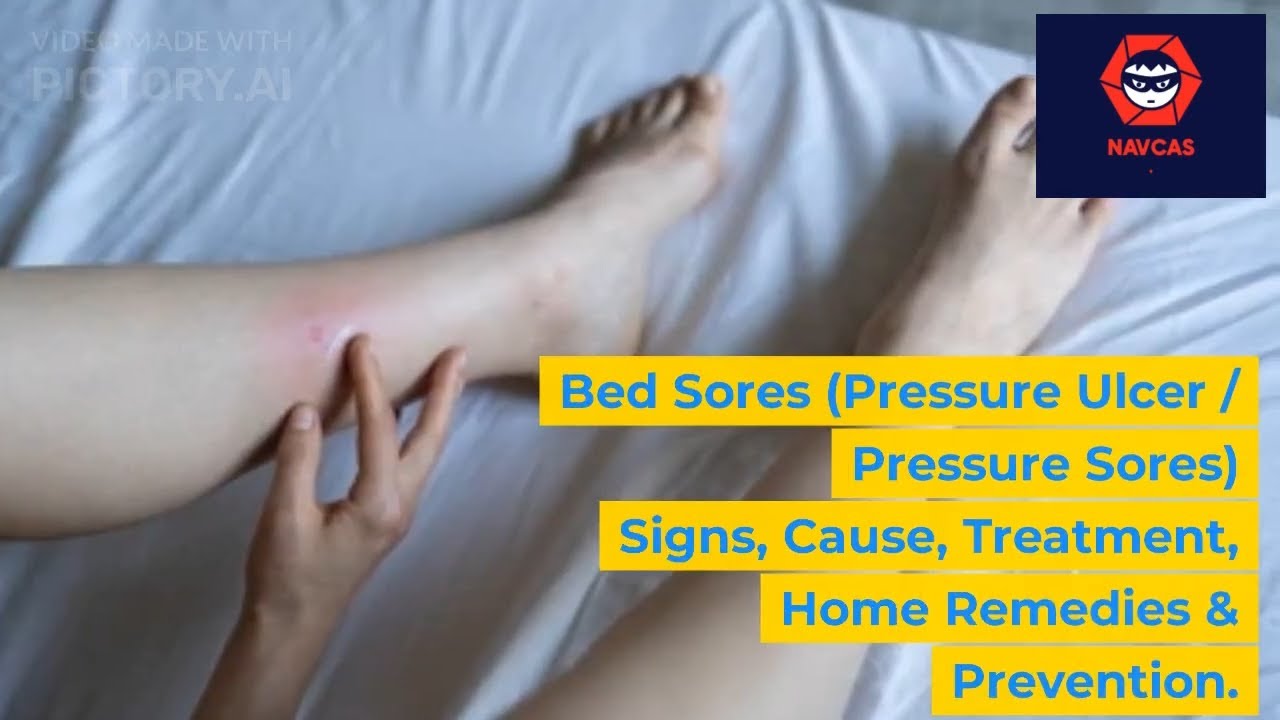 Bed Sores Pressure Sores Pressure Ulcer Signs Causes Treatment Home Remedies Prevention