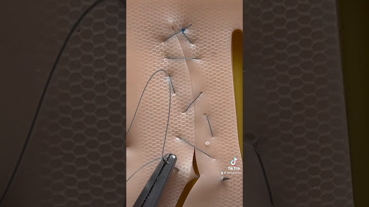 Running combined simple and horizontal mattress suture - YouTube