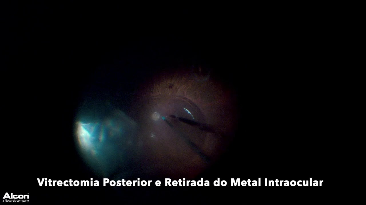 Trauma Ocular Perfurante com Catarata Traumática - YouTube