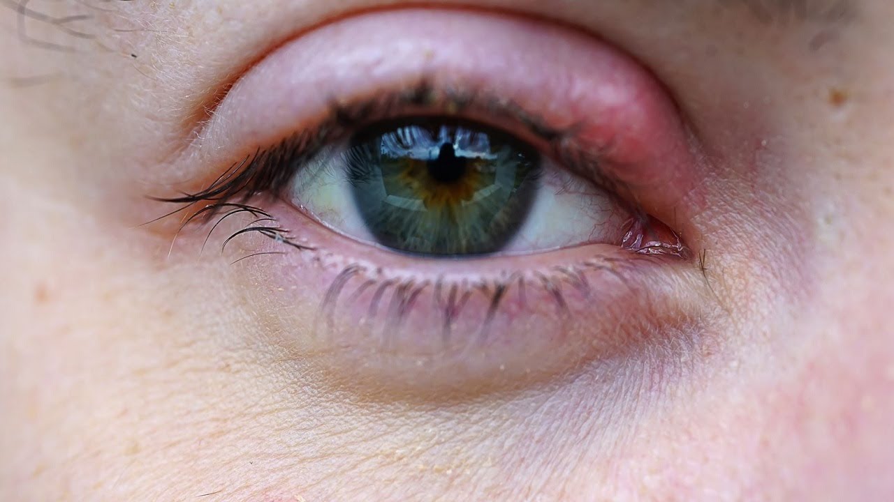 how to get rid of a stye in 2 hours tutorial - YouTube