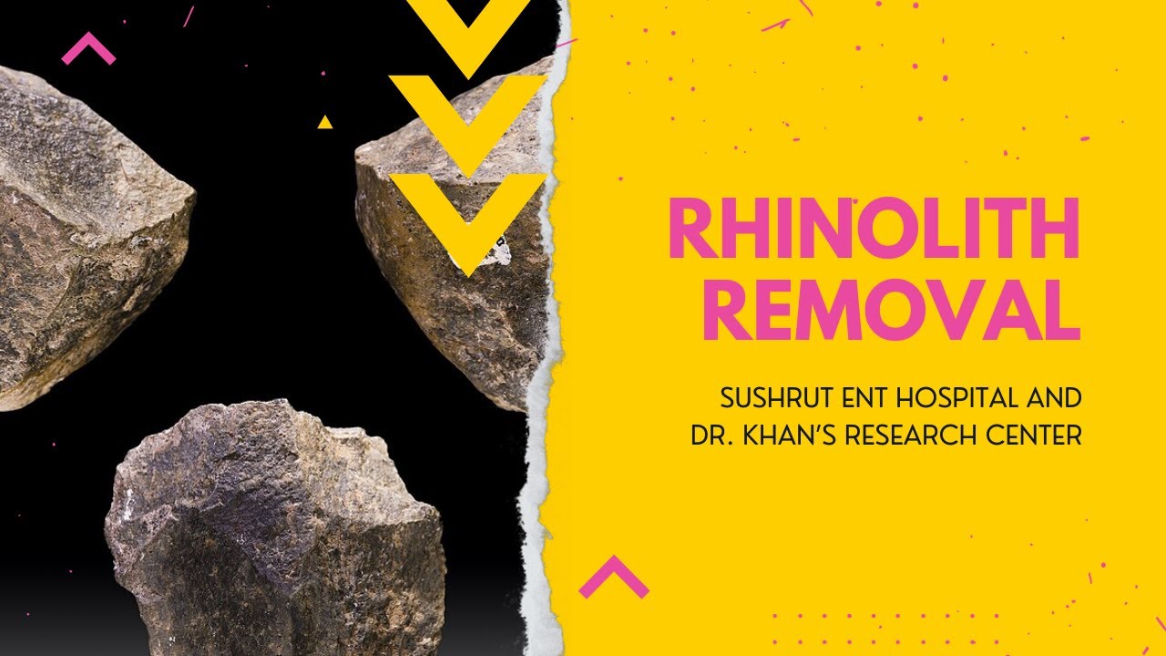 Two handed endoscopic technique of Rhinolith removal - YouTube