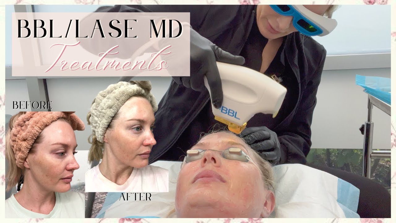 I got a BBL & LASE MD Treatment! Complete process with Before & After ...