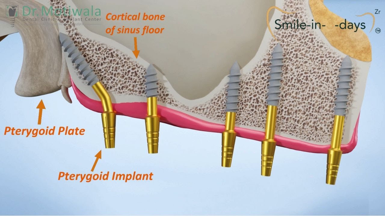 Pterygoid Implant placement © 3D Animation video - YouTube