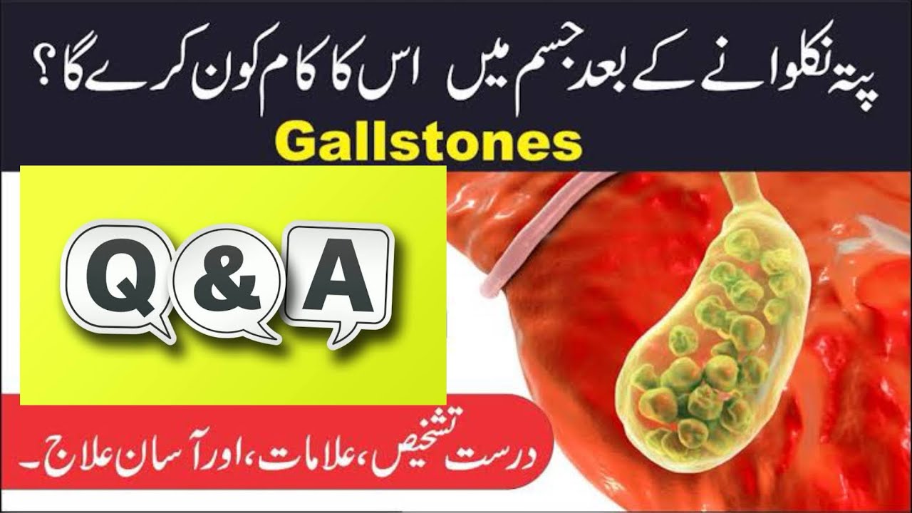 Gall Stones Common Questions In Urdu | Cholelithiasis In Urdu | Q & A ...