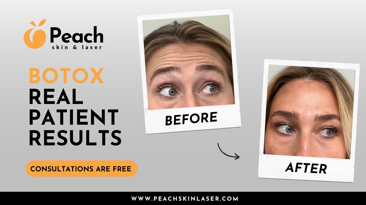 Try Botox at Peach Skin & Laser! - YouTube