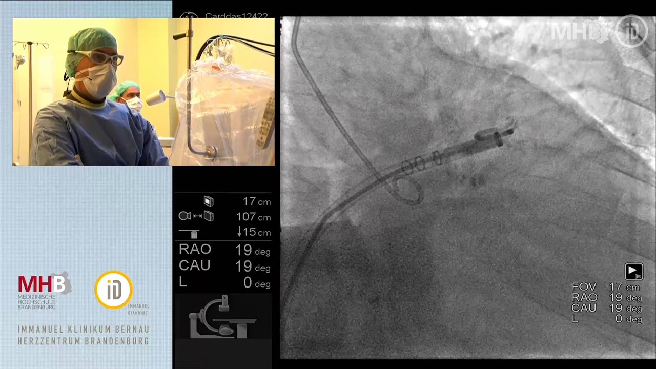 Watchman Implantation (1/2) - YouTube