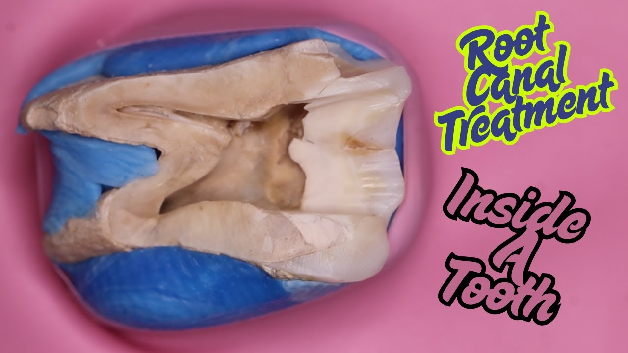 What Happens Inside A Tooth During Root Canal Treatment - YouTube