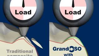 Grandio SO Flowable Voco 2723 Composite Syringe, A2 Shade, 2g Volume ...